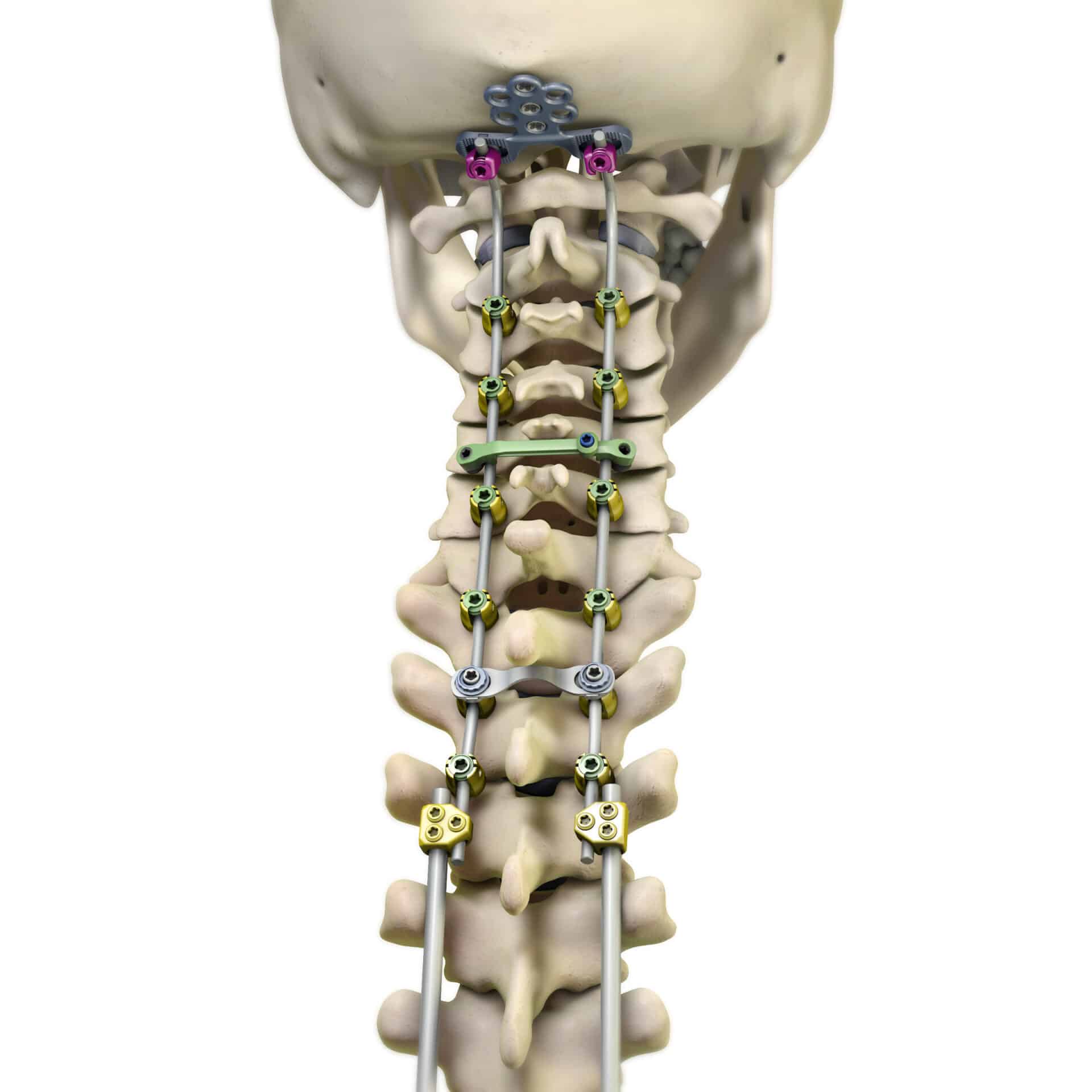 Virage® OCT Spinal Fixation System – Highridge Medical