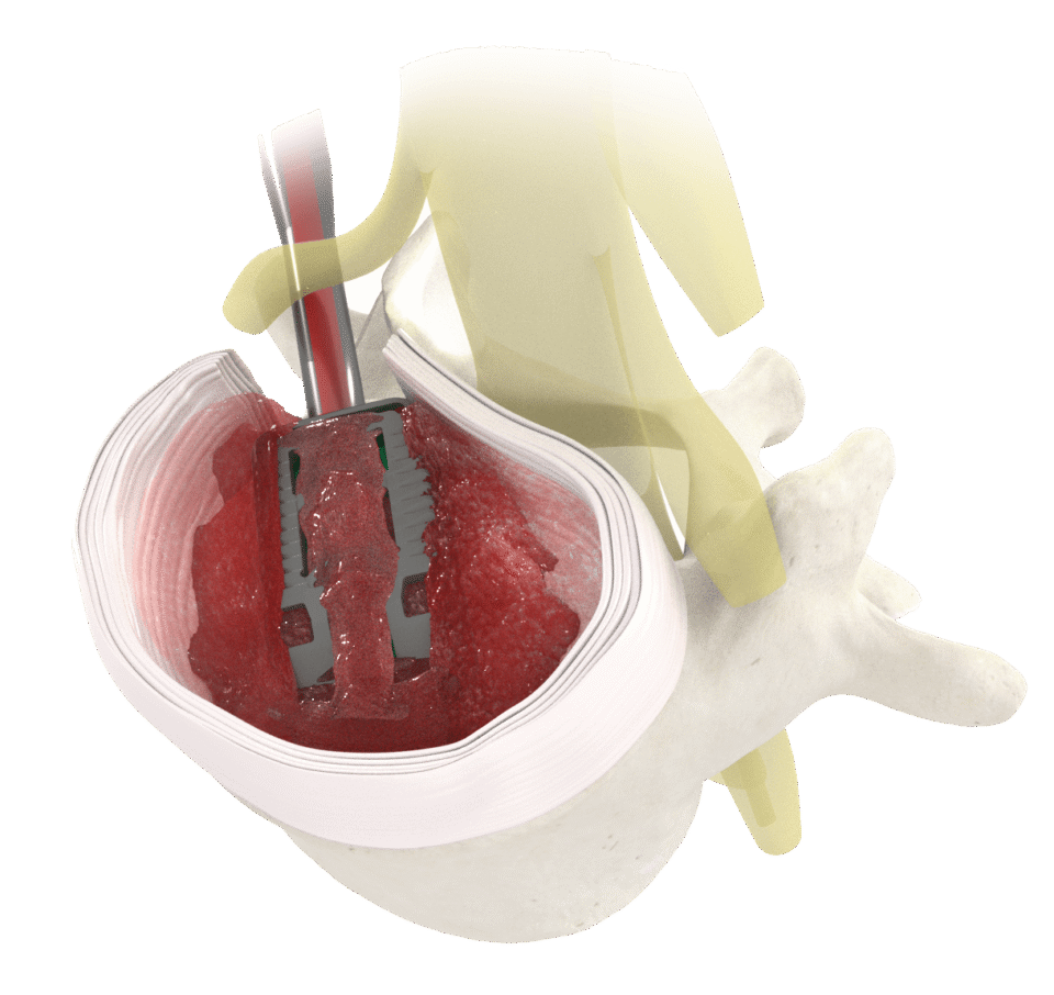 FlareHawk® Interbody Fusion System – Highridge Medical